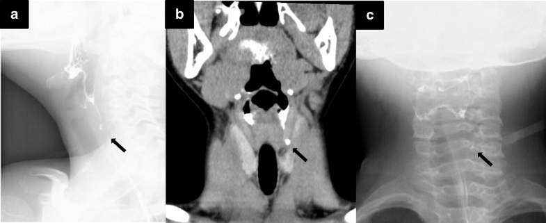 Microlaryngoscopic surgery for pyriform sinus fistulas in children: a ...