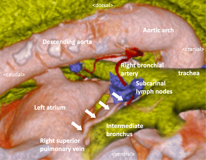 Thoracoscopic esophagectomy with subcarinal lymph node dissection in the prone position for ...