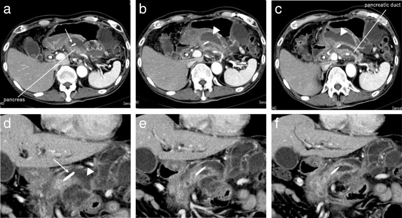 A case of perforation of a pancreatic duct by a pancreatic stent during ...