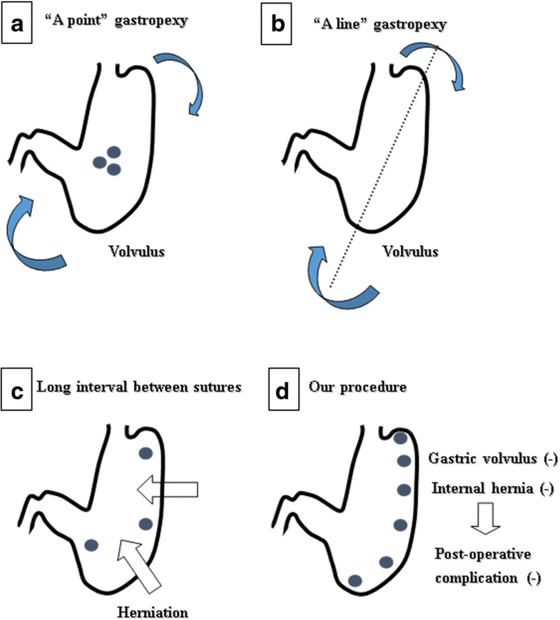 Single-incision laparoscopic gastropexy for mesentero-axial gastric ...