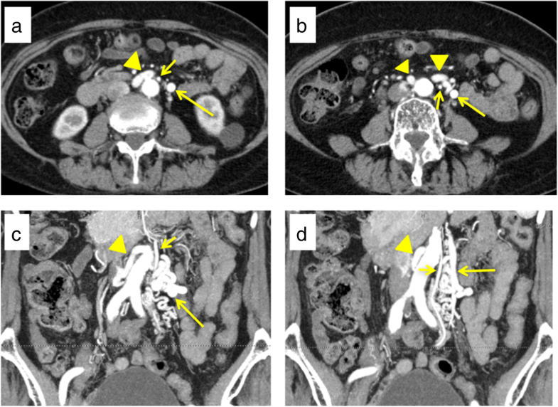 Surgical treatment of rectal cancer with a Retzius shunt: a case report ...