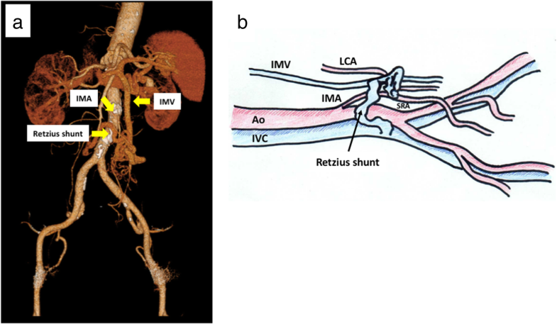 Surgical treatment of rectal cancer with a Retzius shunt: a case report ...