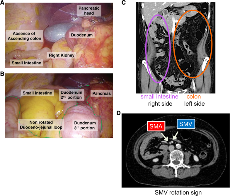 Laparoscopic distal gastrectomy for gastric cancer patient with ...