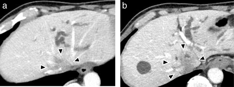Left trisectionectomy combined with resection of the right hepatic vein ...