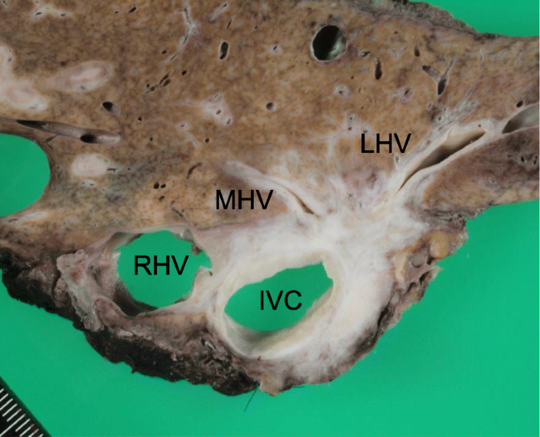 Left trisectionectomy combined with resection of the right hepatic vein ...