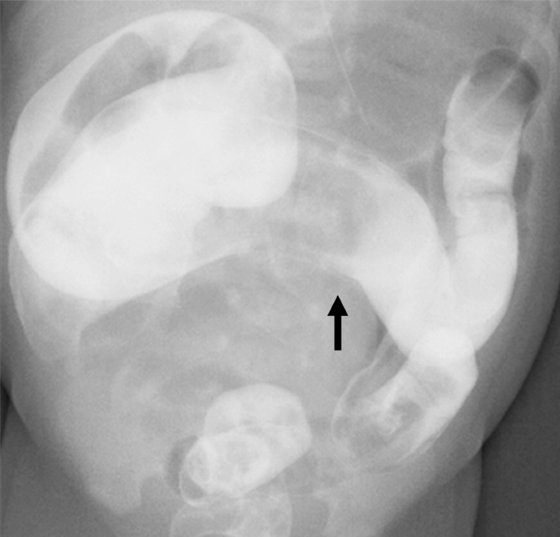 Blowhole tangential cecostomy and transanal tube insertion for neonatal ...