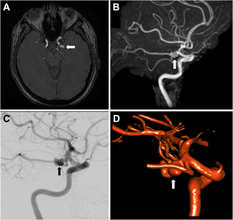 Imaging of cerebral aneurysms: a clinical perspective | Neurovascular Imaging | Full Text