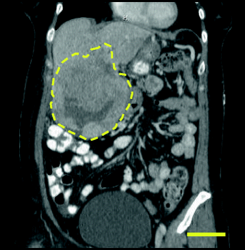 Subcutaneous glucagon infusion and continuous glucose monitoring enable ...