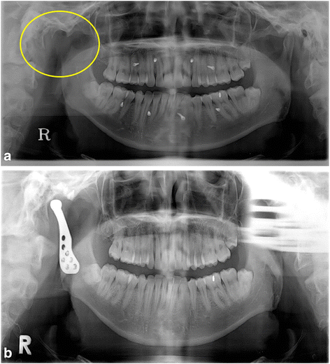 Temporomandibular joint reconstruction with alloplastic prosthesis: the ...