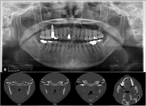 Robot-assisted submandibular gland excision via modified facelift ...