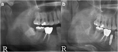 Intentional partial odontectomy—a long-term follow-up study ...