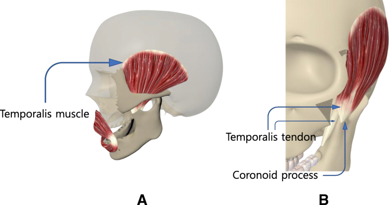 Management of the paralyzed face using temporalis tendon transfer via ...