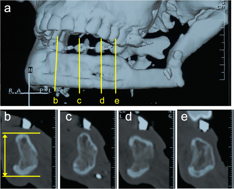 Vertical distraction osteogenesis of a reconstructed mandible with a ...