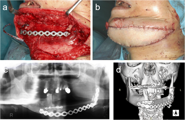 Vertical distraction osteogenesis of a reconstructed mandible with a ...