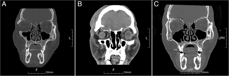 Reconstruction of the orbital wall using superior orbital rim osteotomy ...