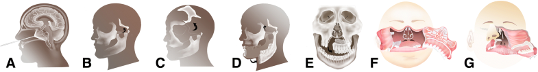 Infratemporal fossa approach: the modified zygomatico-transmandibular ...