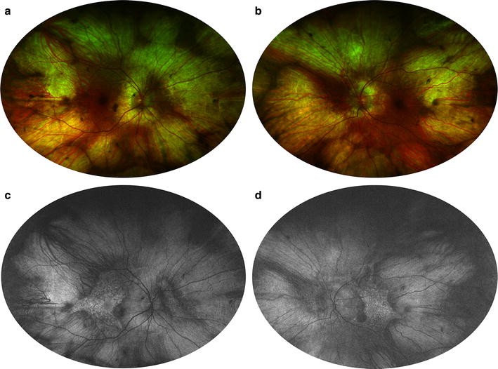 Clinical applications of fundus autofluorescence in retinal disease ...