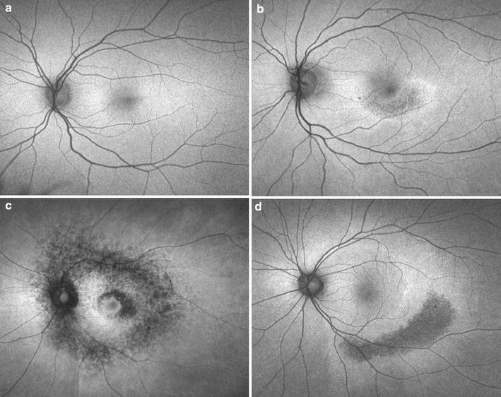 Clinical applications of fundus autofluorescence in retinal disease ...