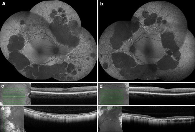 Clinical applications of fundus autofluorescence in retinal disease ...