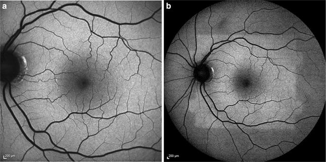 Clinical applications of fundus autofluorescence in retinal disease ...