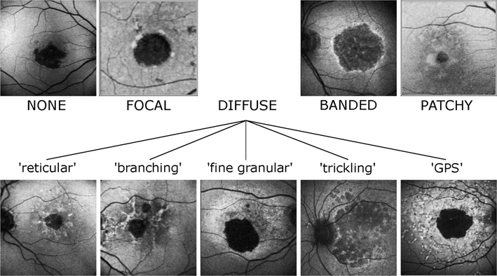 Clinical applications of fundus autofluorescence in retinal disease ...