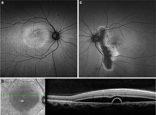 Clinical applications of fundus autofluorescence in retinal disease ...