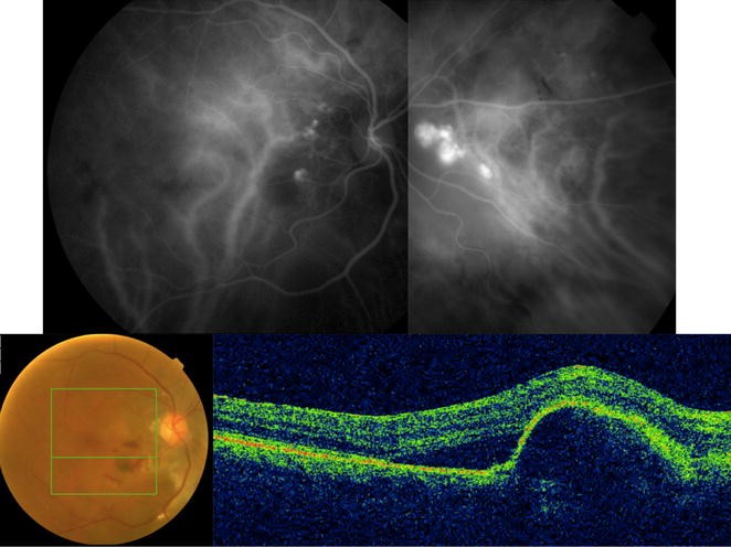 Characteristics and racial variations of polypoidal choroidal ...
