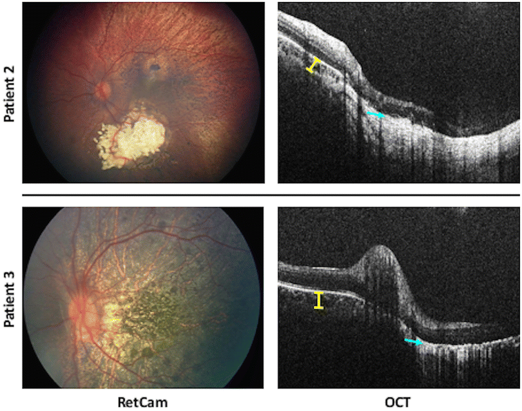 Choroidal infarction following ophthalmic artery chemotherapy ...