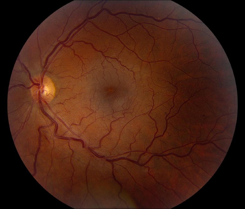 Acute retinal vein occlusion and cystic fibrosis | International ...