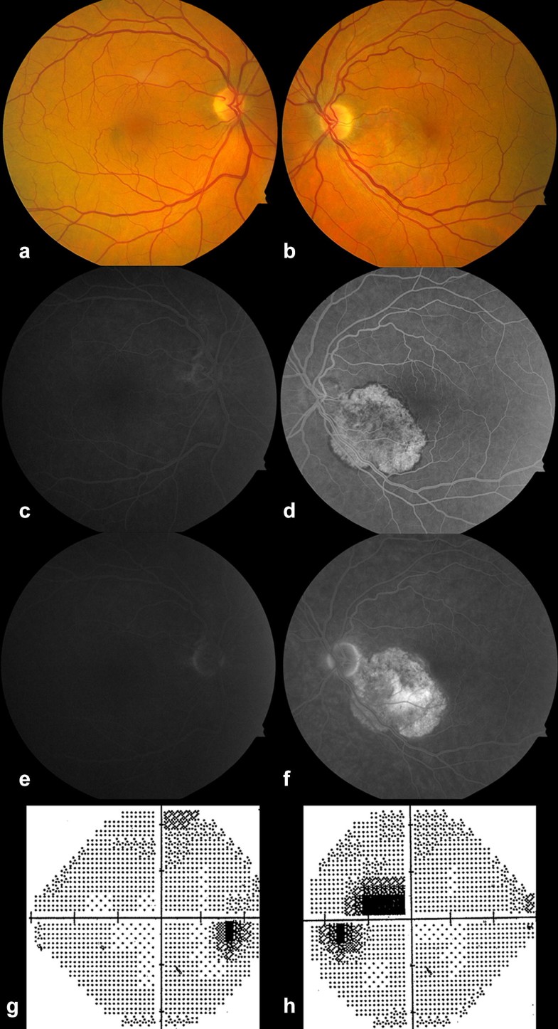 Clinical course of acute zonal occult outer retinopathy complicated by ...