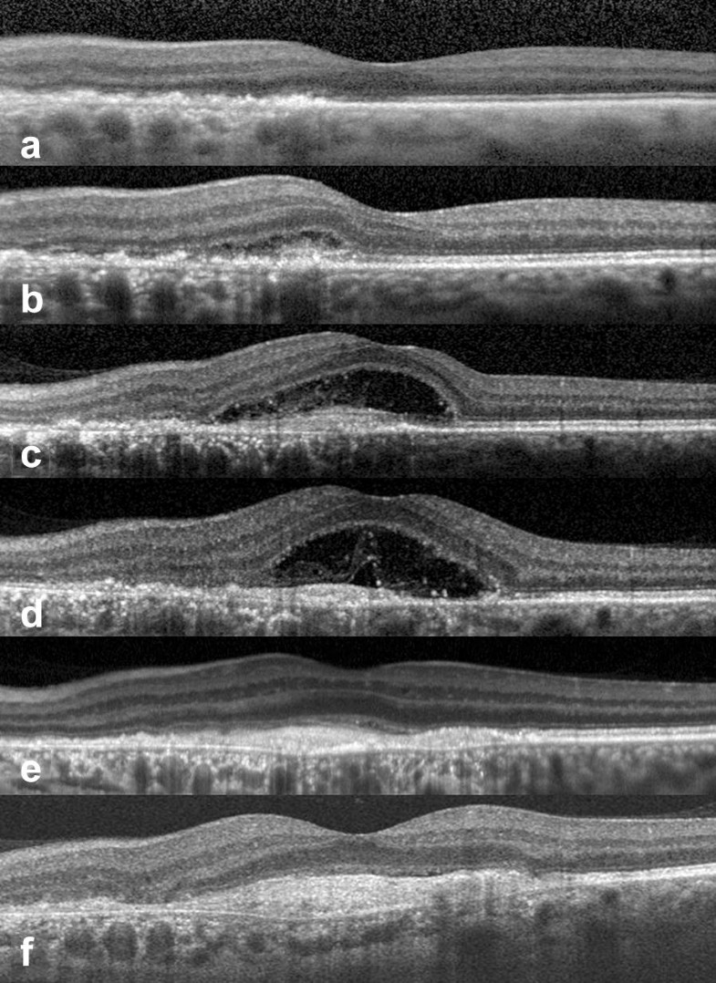 Clinical course of acute zonal occult outer retinopathy complicated by ...