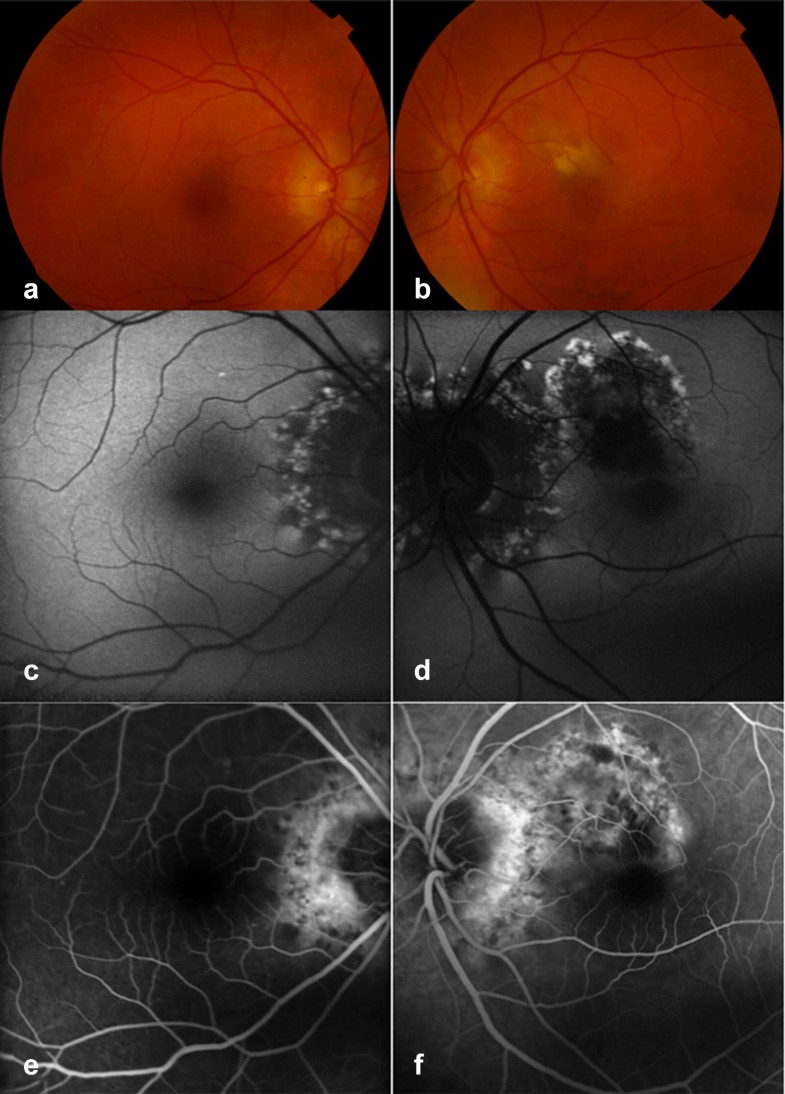 Clinical course of acute zonal occult outer retinopathy complicated by ...