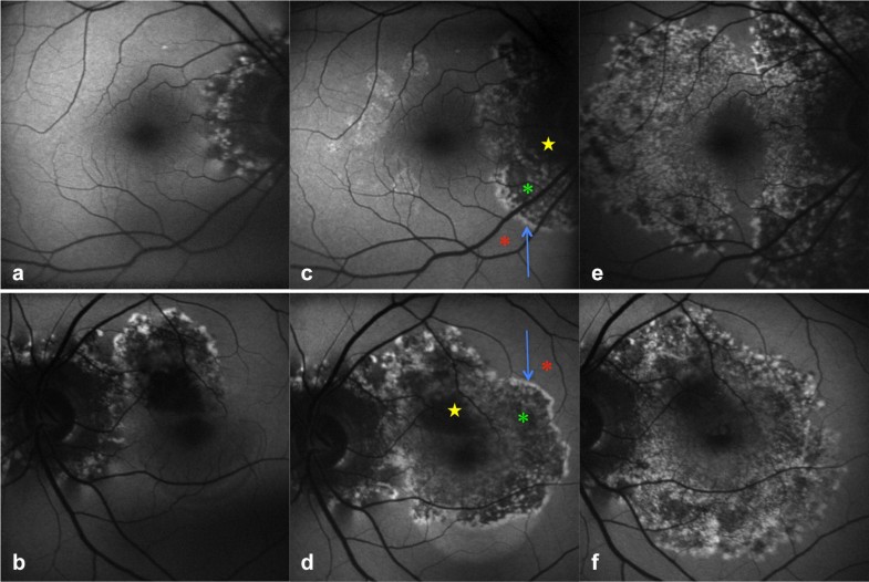 Clinical course of acute zonal occult outer retinopathy complicated by ...