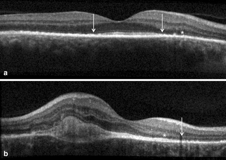 Clinical course of acute zonal occult outer retinopathy complicated by ...