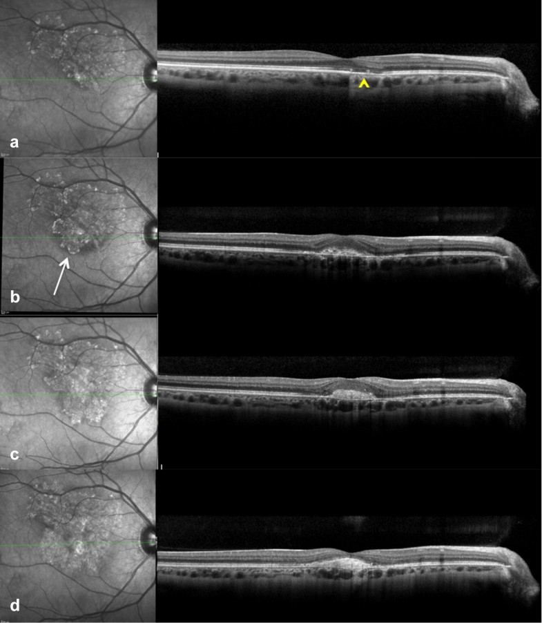 Clinical course of acute zonal occult outer retinopathy complicated by ...