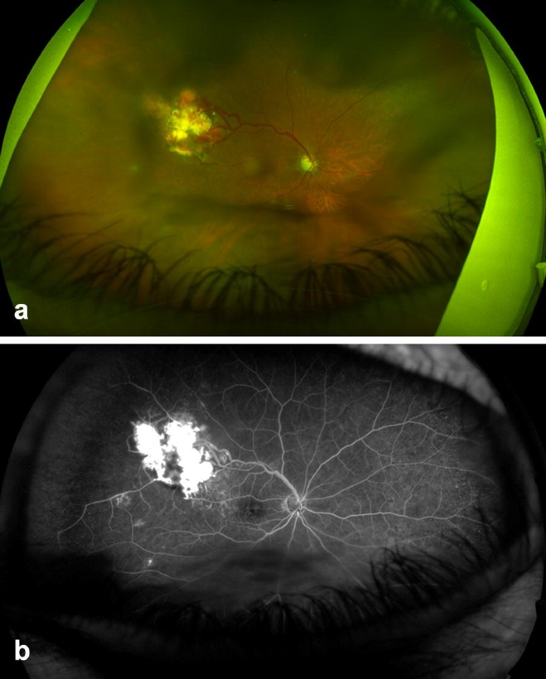 Peripheral retinal nonperfusion using widefield imaging with von Hippel ...