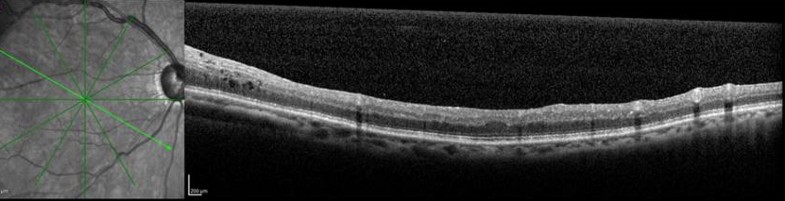 Peripheral retinal nonperfusion using widefield imaging with von Hippel ...