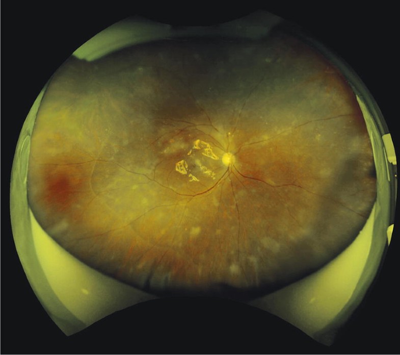 Multimodal imaging of retinal metastasis masquerading as an acute ...
