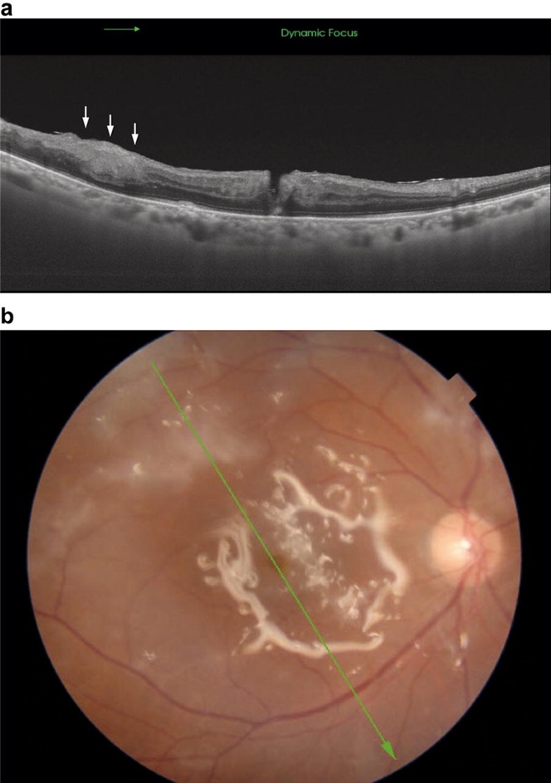 Multimodal imaging of retinal metastasis masquerading as an acute ...