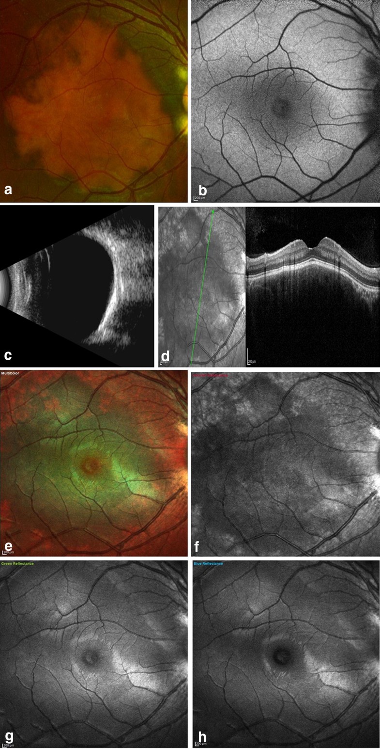 Multicolor imaging in choroidal osteomas | International Journal of ...