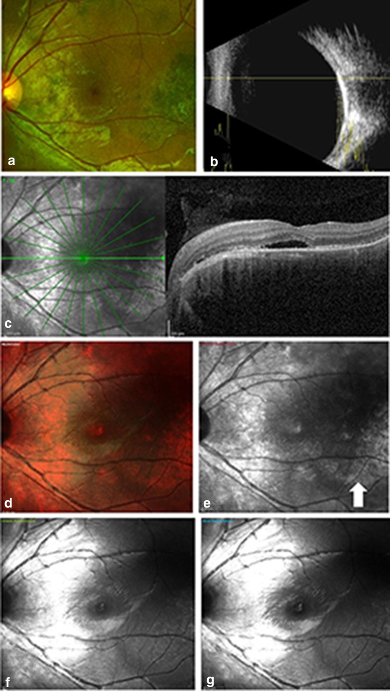 Multicolor imaging in choroidal osteomas | International Journal of ...