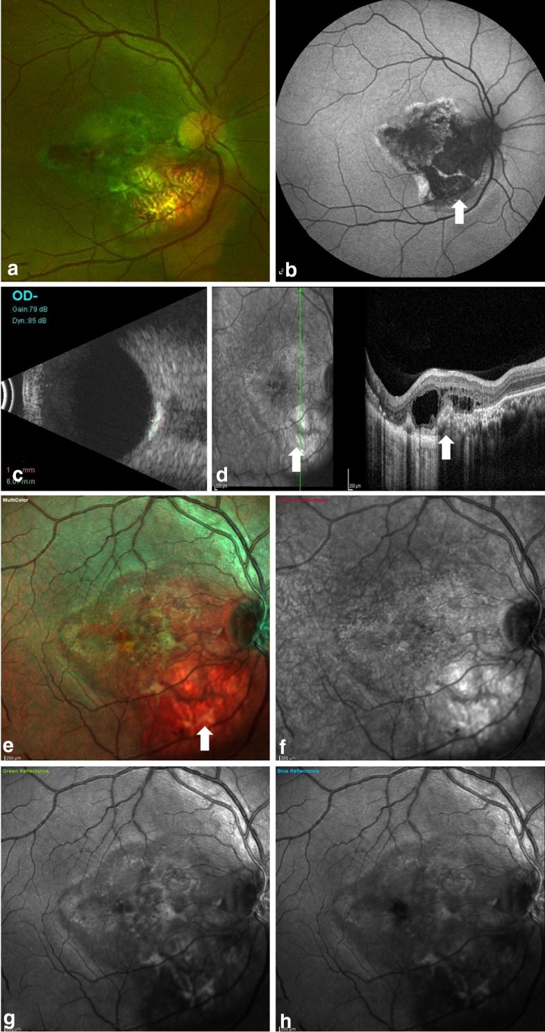 Multicolor imaging in choroidal osteomas | International Journal of Retina and Vitreous | Full Text