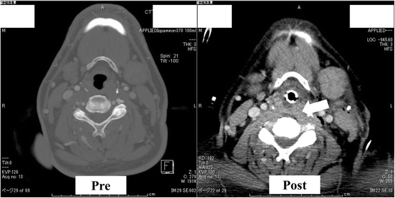 A case of anesthesia mumps that required postoperative re-intubation ...