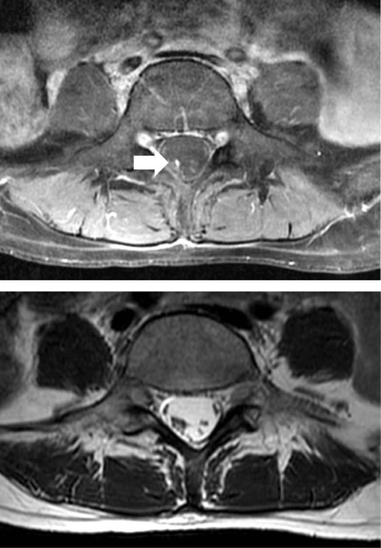 Repeat epidural blood patch at the level of unintentional dural ...