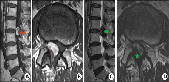 Classification, mechanism and surgical treatments for spinal canal ...