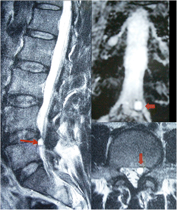 Classification, mechanism and surgical treatments for spinal canal ...