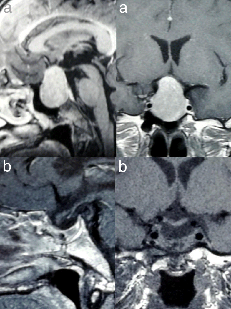 A study on sublabial transsphenoidal treatment of pituitary tumor under ...