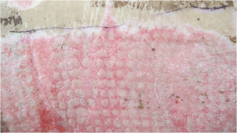 Retrospective review of a tertiary adult burn centre’s experience with ...