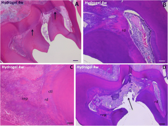 Reactionary and reparative dentin formation after pulp capping ...