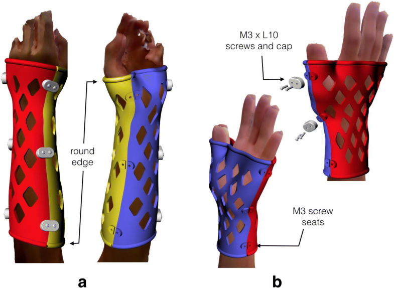 Rapid customization system for 3D-printed splint using programmable ...